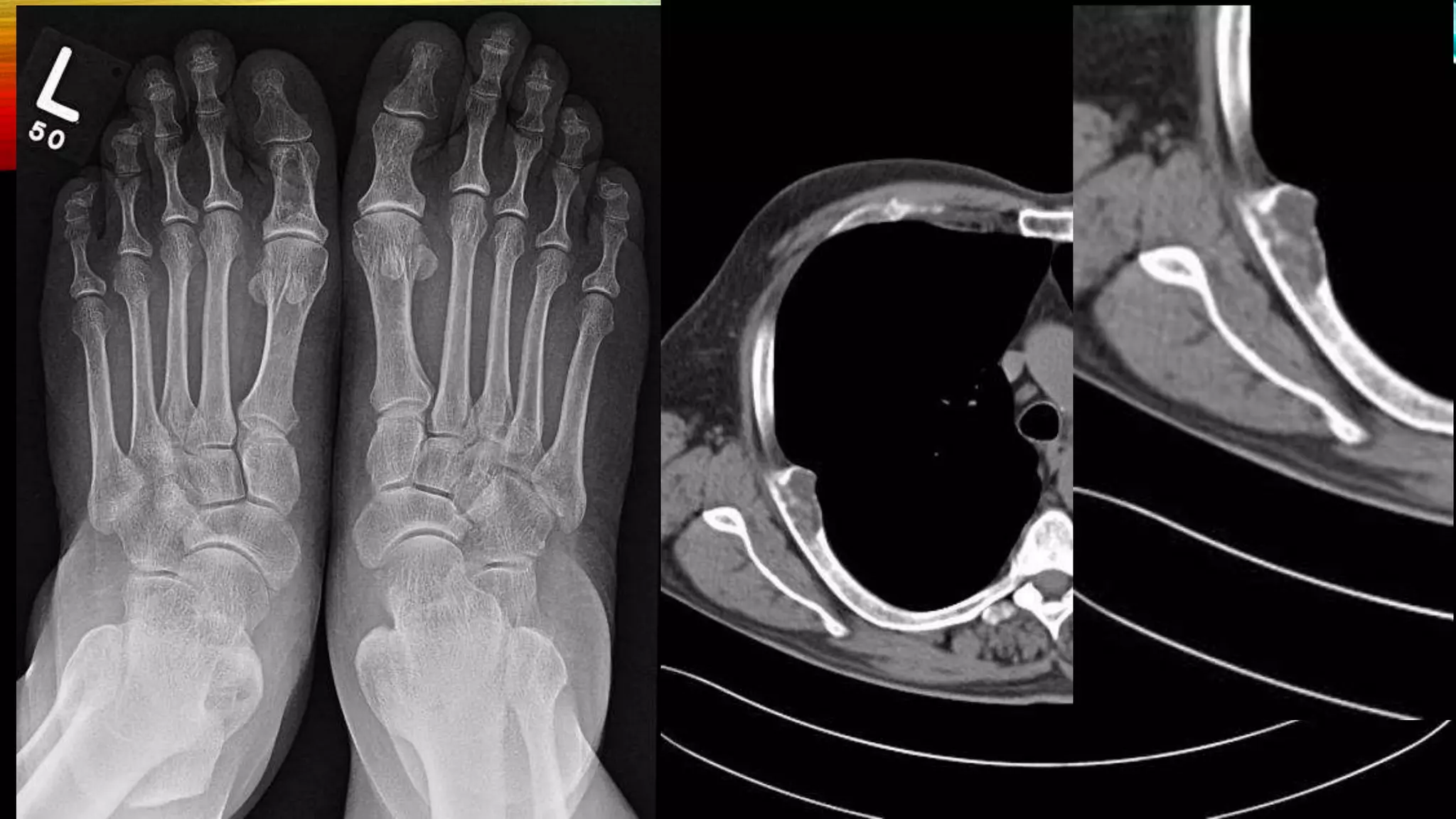 Benign Bone Tumours Pptx