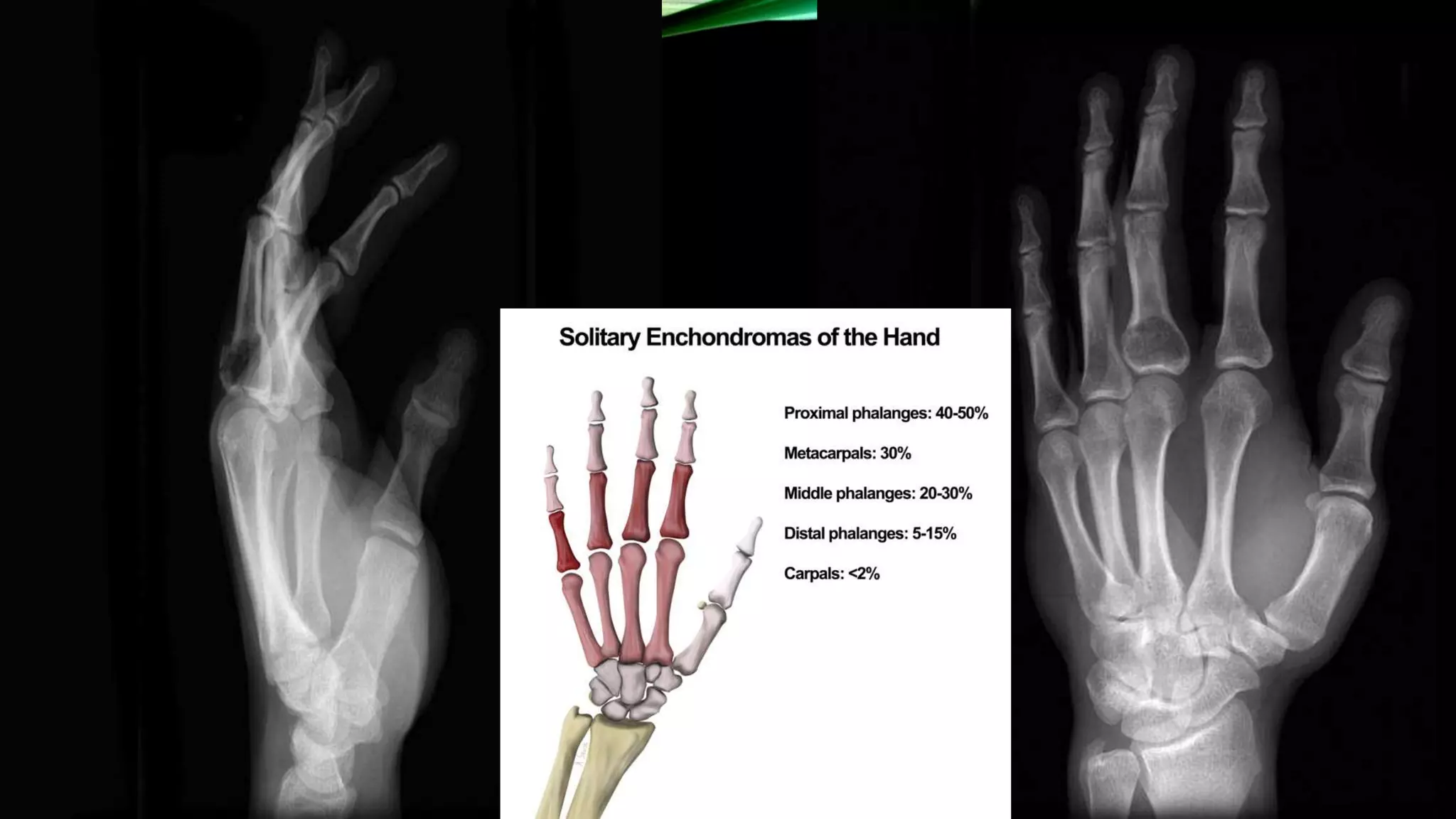 Benign Bone Tumours Pptx