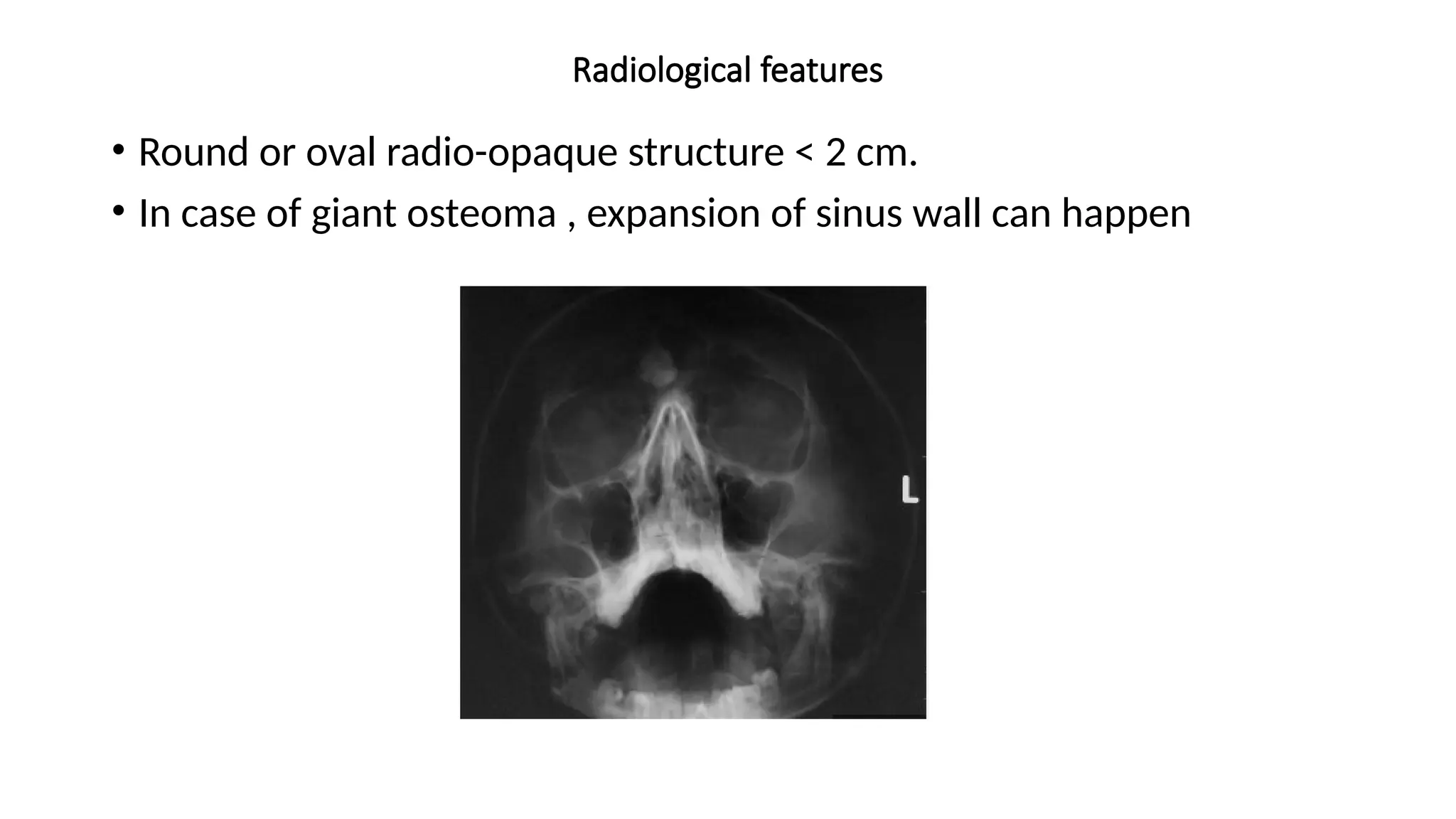 BENIGN BONE TUMOURS ppt classification Radiology | PPT