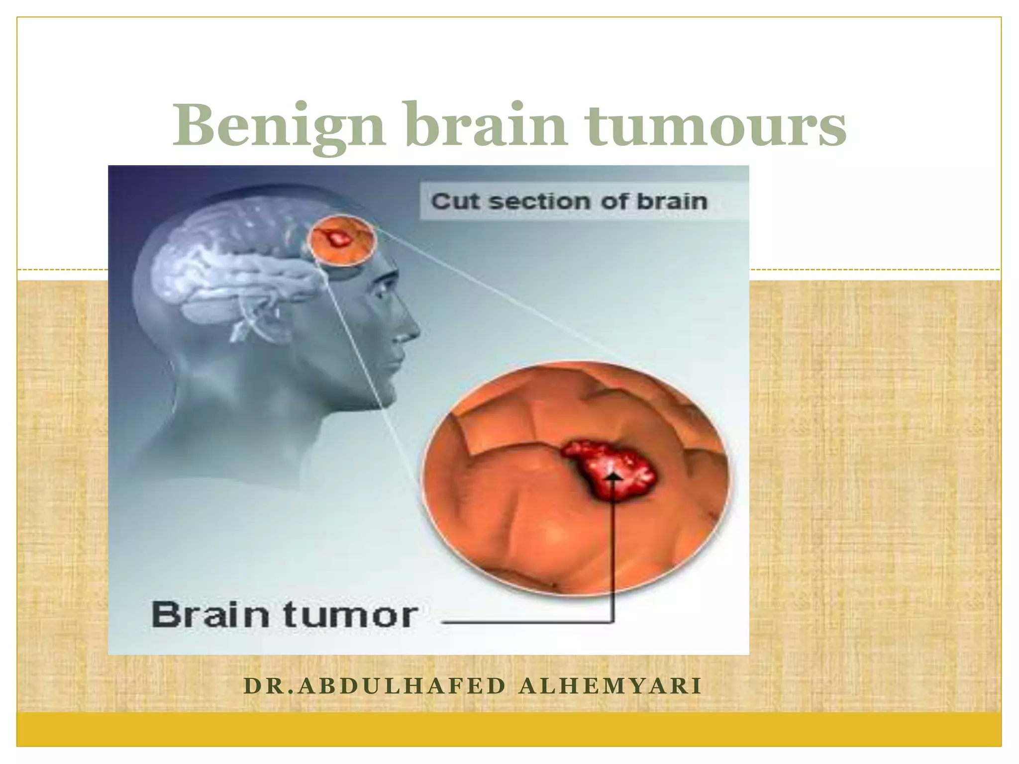Benign brain tumours | PPTX