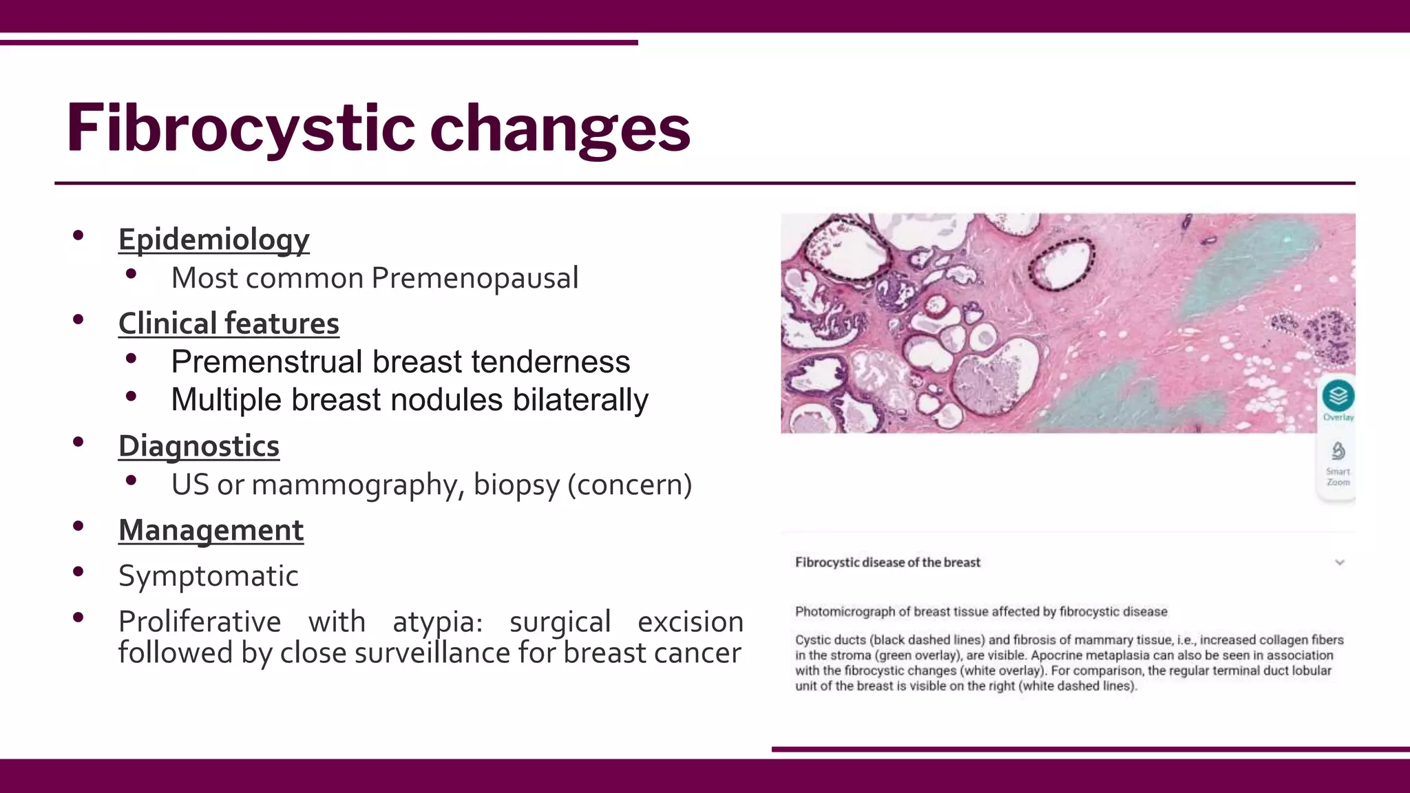 Benign breast conditions.pptx