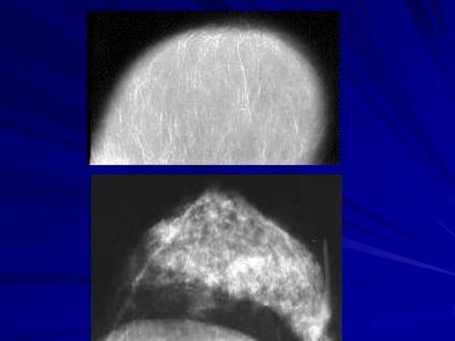 Benign breast disease | PPT