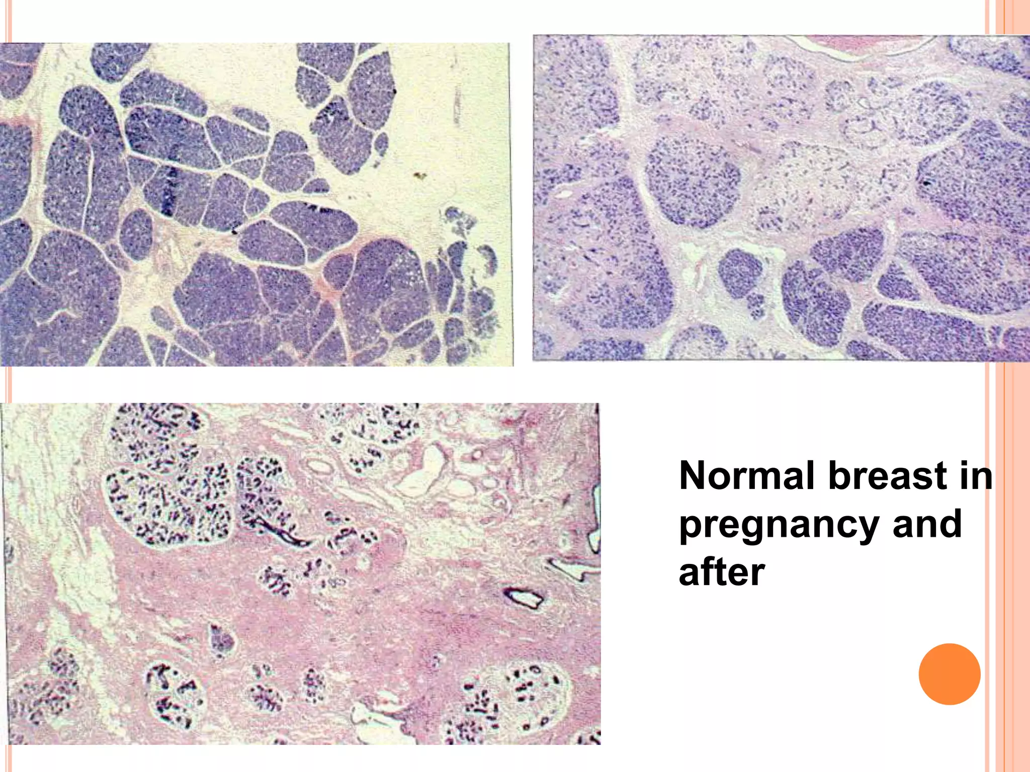 Benign breast disease | PPT