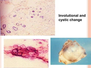 Benign breast disease | PPT