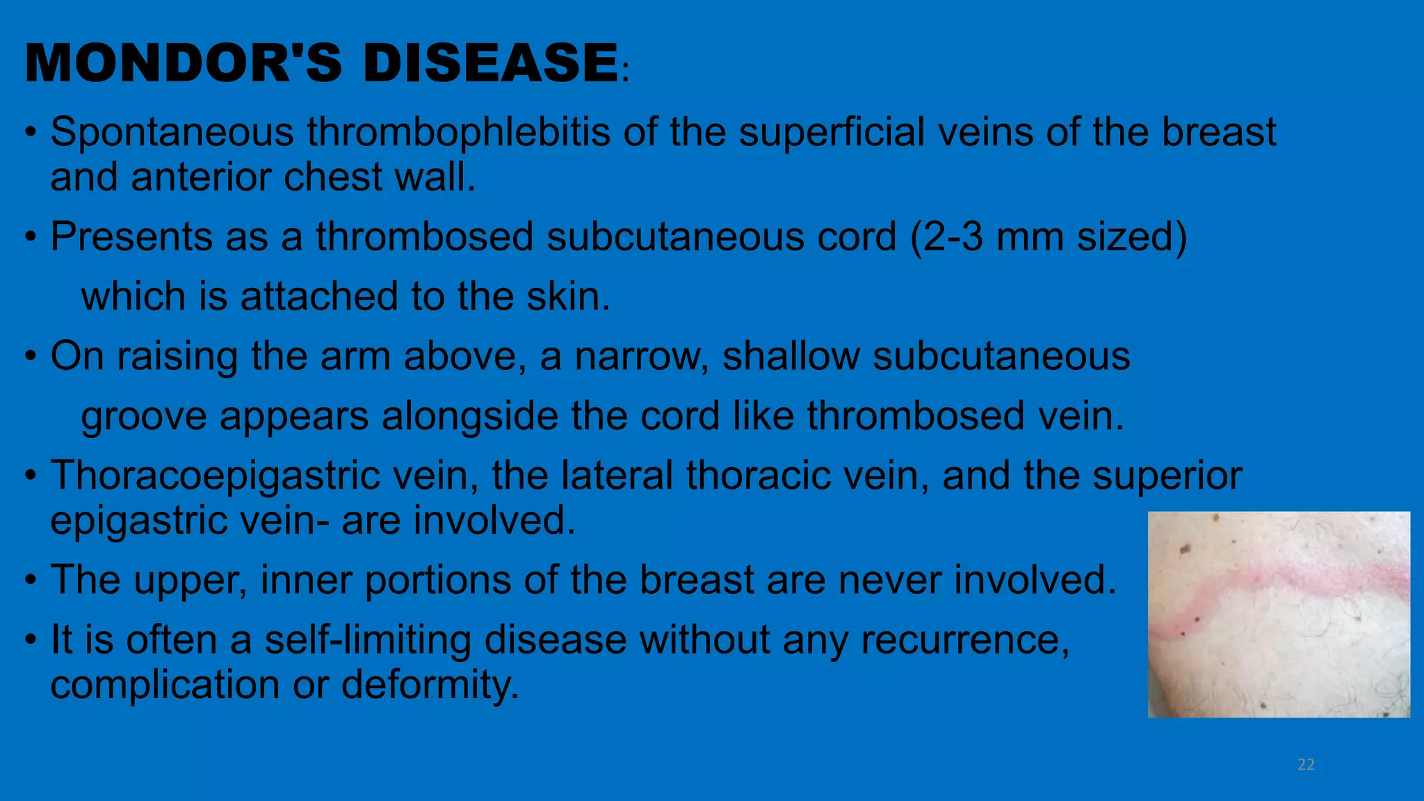 BENIGN BREAST DISEASE copy.pptx