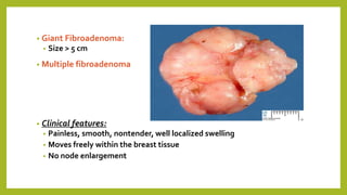 benign breast diseases..ppt presentation | PPTX