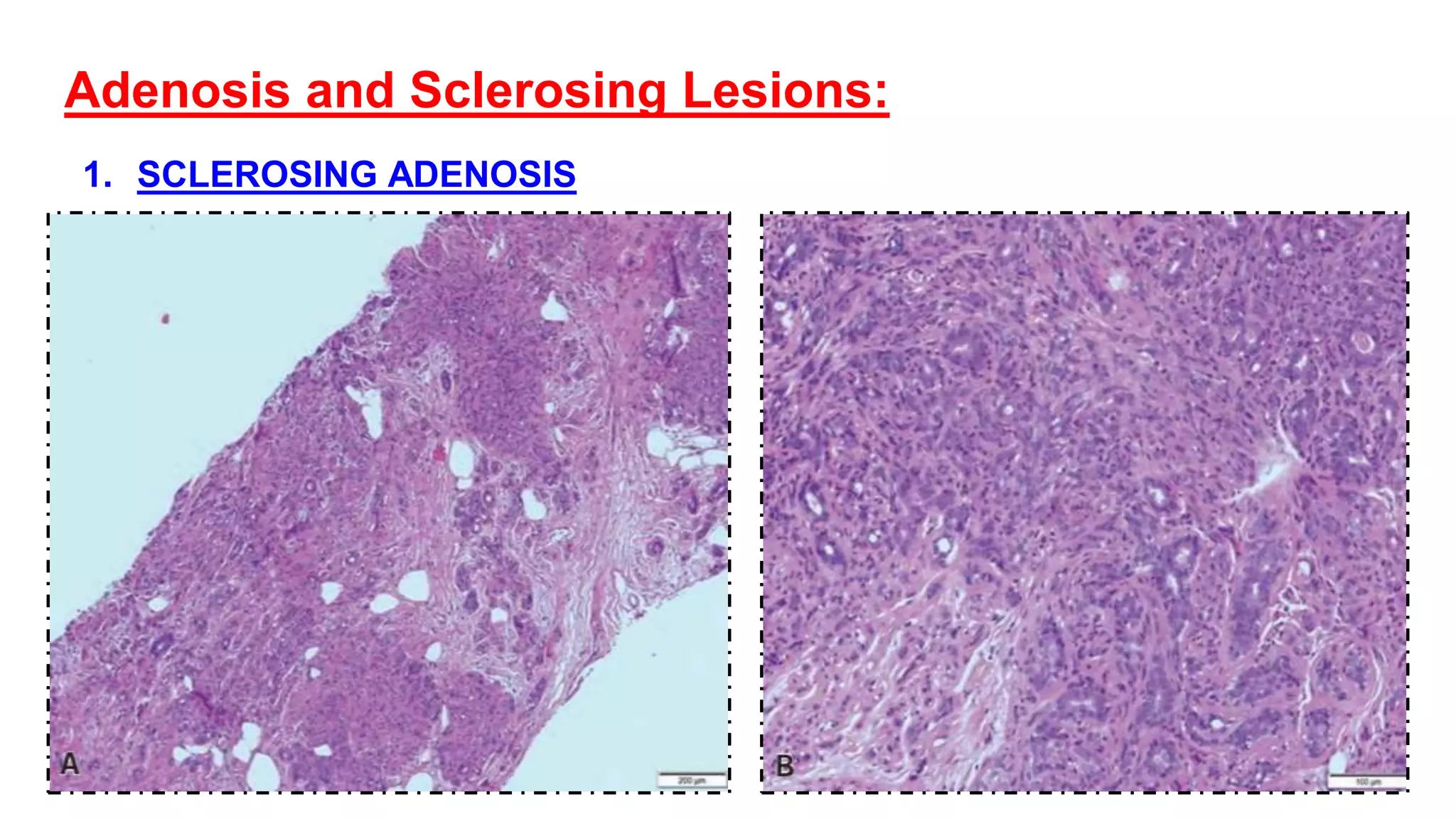 BENIGN BREAST DISEASES (PATHOLOGY).pptx