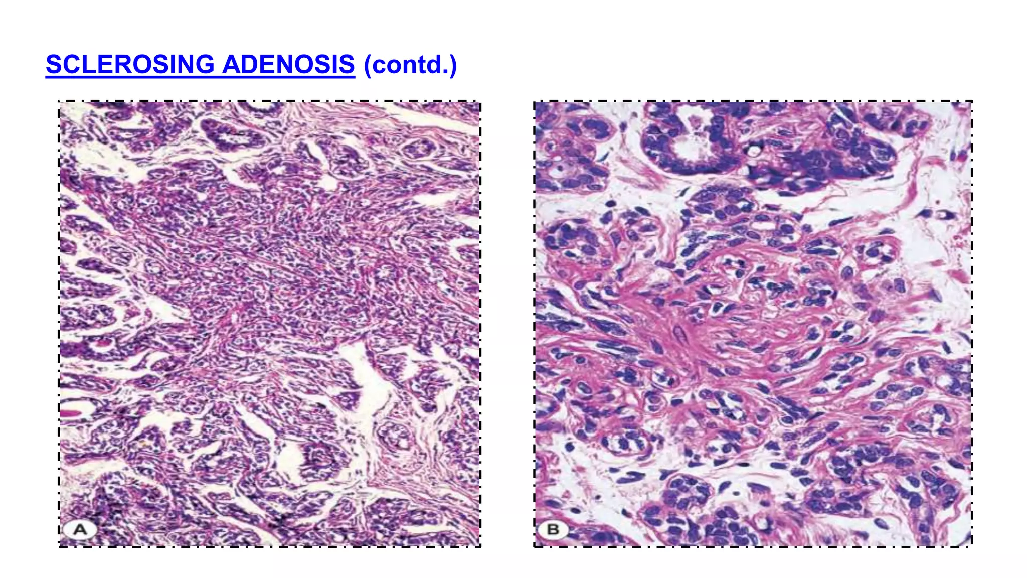 BENIGN BREAST DISEASES (PATHOLOGY).pptx