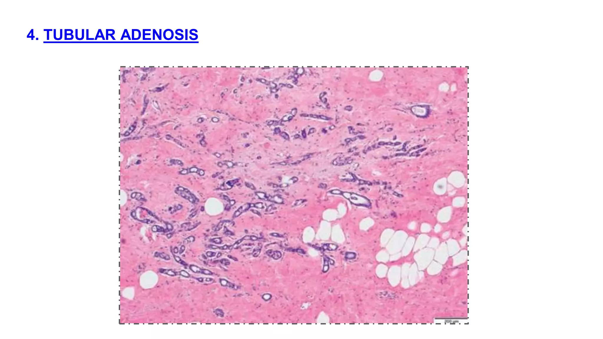 BENIGN BREAST DISEASES (PATHOLOGY).pptx