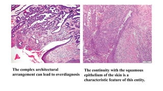 Benign breast lesions.pptx benign breast lesions | PPTX