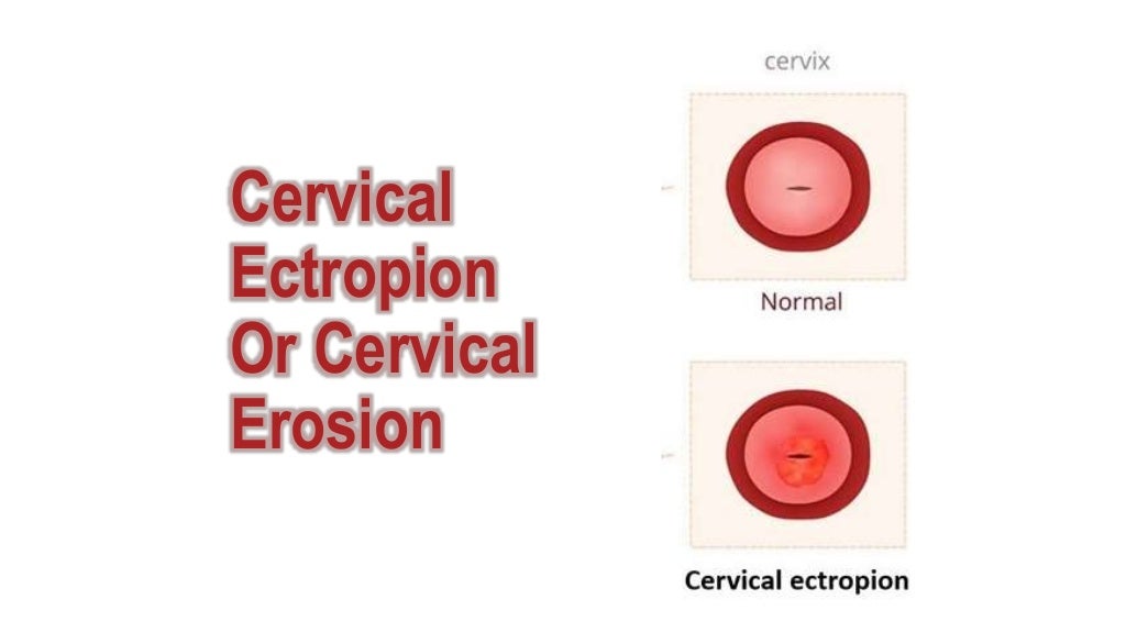 Benign Cervical Lesions