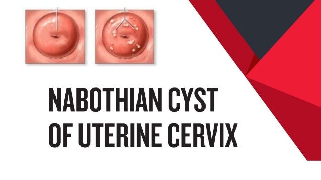 Benign Cervical Lesions