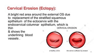 benigncervicallesions-180223153134 (1).pptx