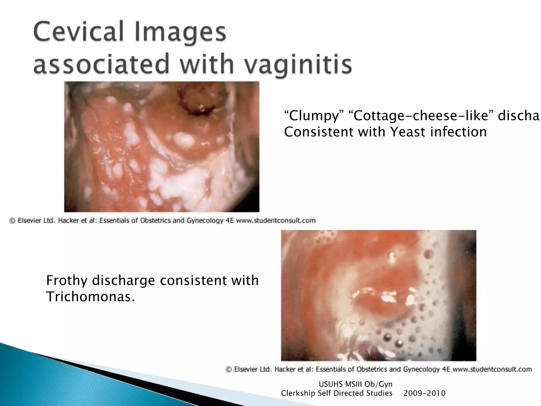 Benign conditions of vagina | PPTX