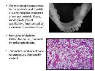 benign connective tissue tumors of osseous chondroid myxoid adipose.pptx