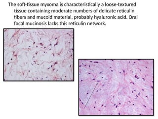 benign connective tissue tumors of osseous chondroid myxoid adipose.pptx