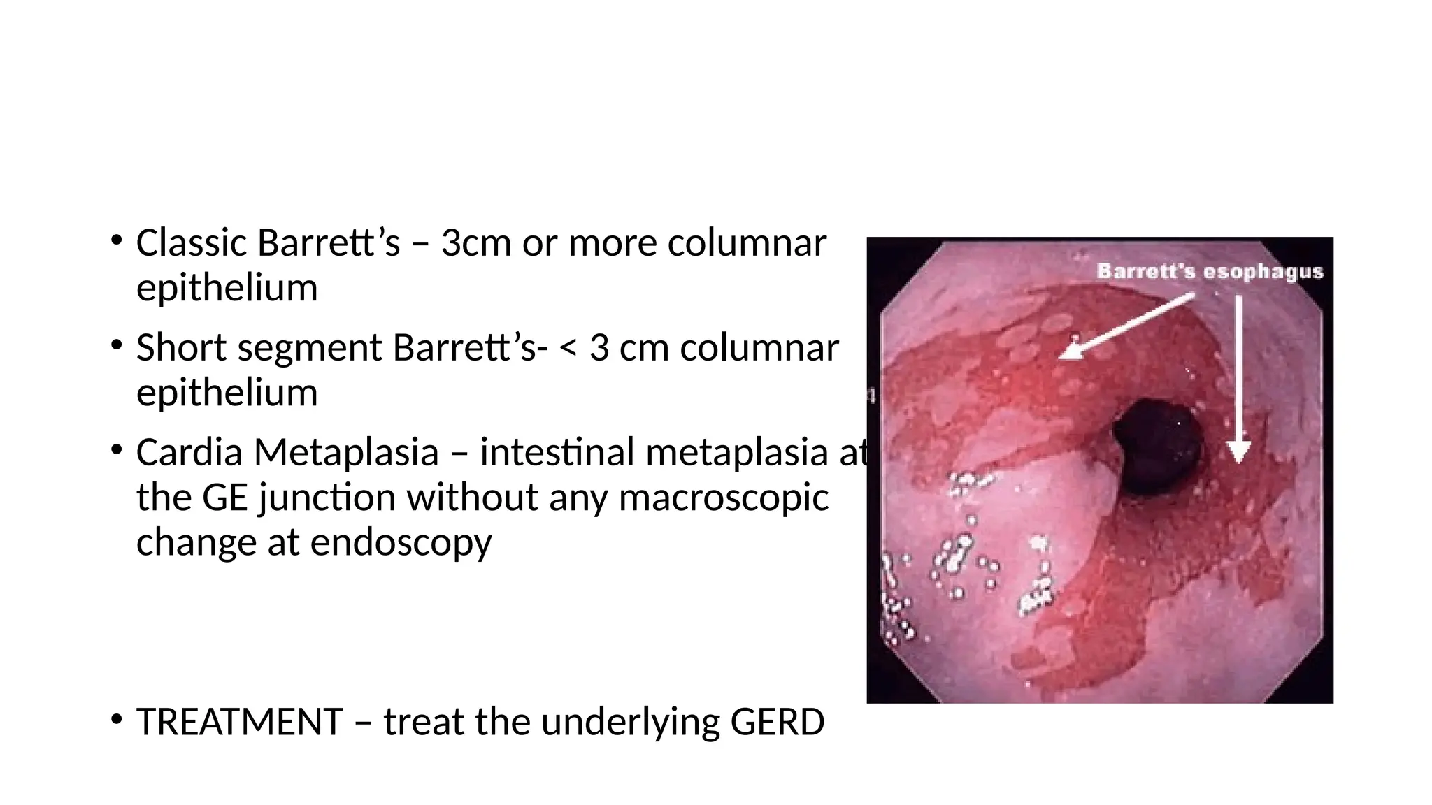 Benign diseases of esophagus in patients.pptx