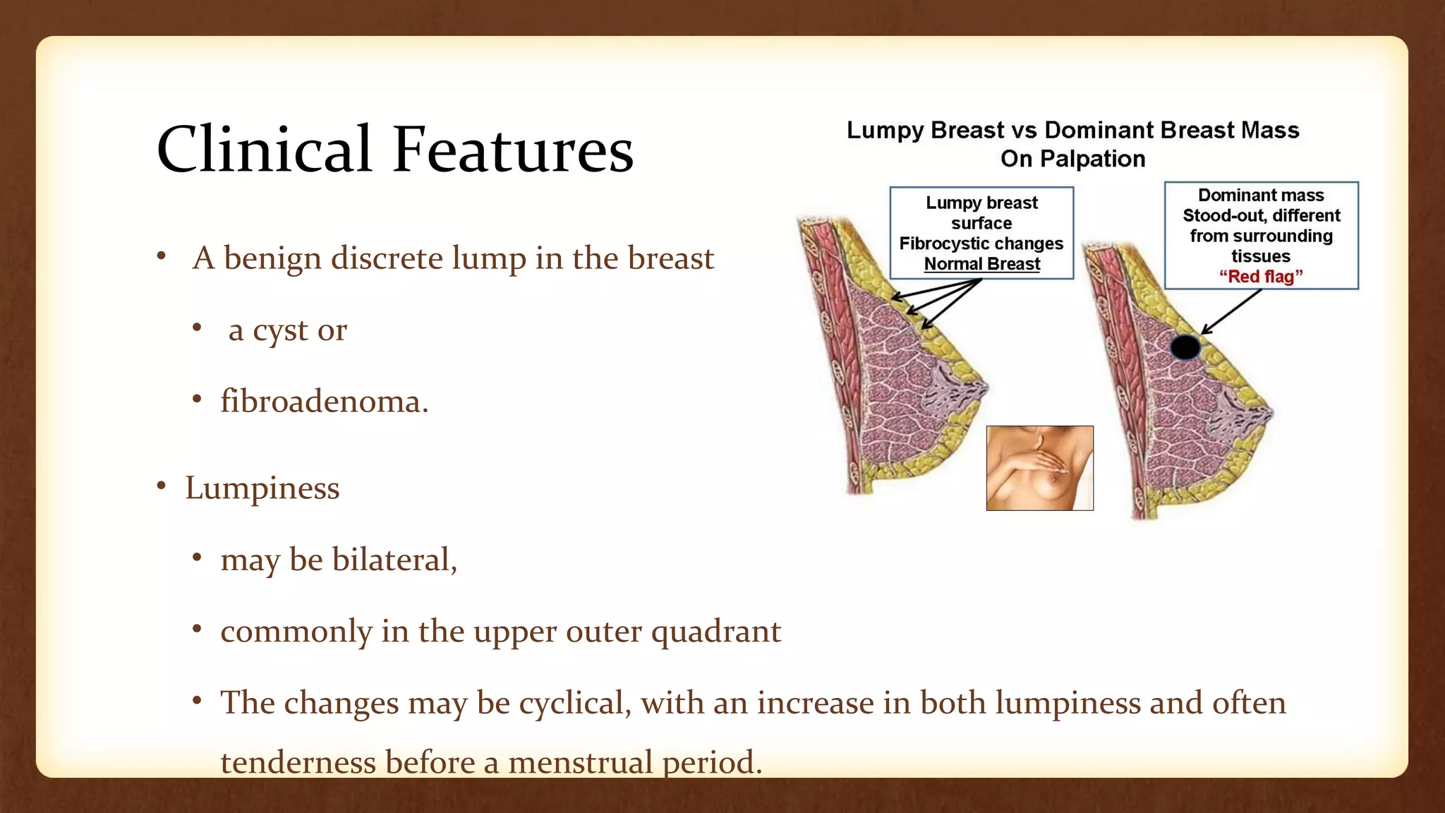 Benign diseases of breast | PPT