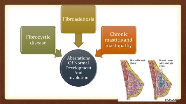 Benign diseases of breast | PPT