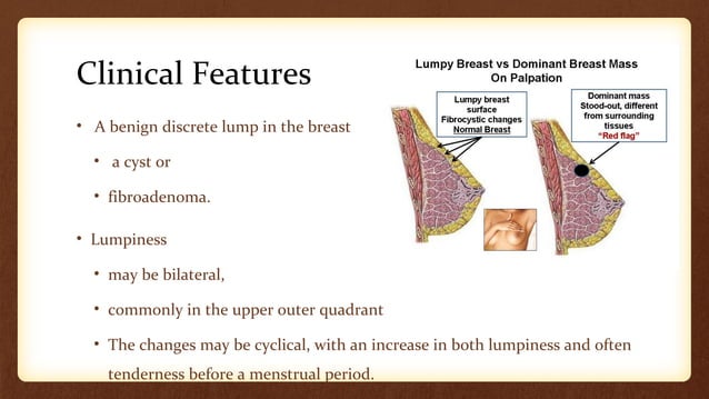 Benign diseases of breast