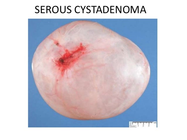 Benign diseases of ovary