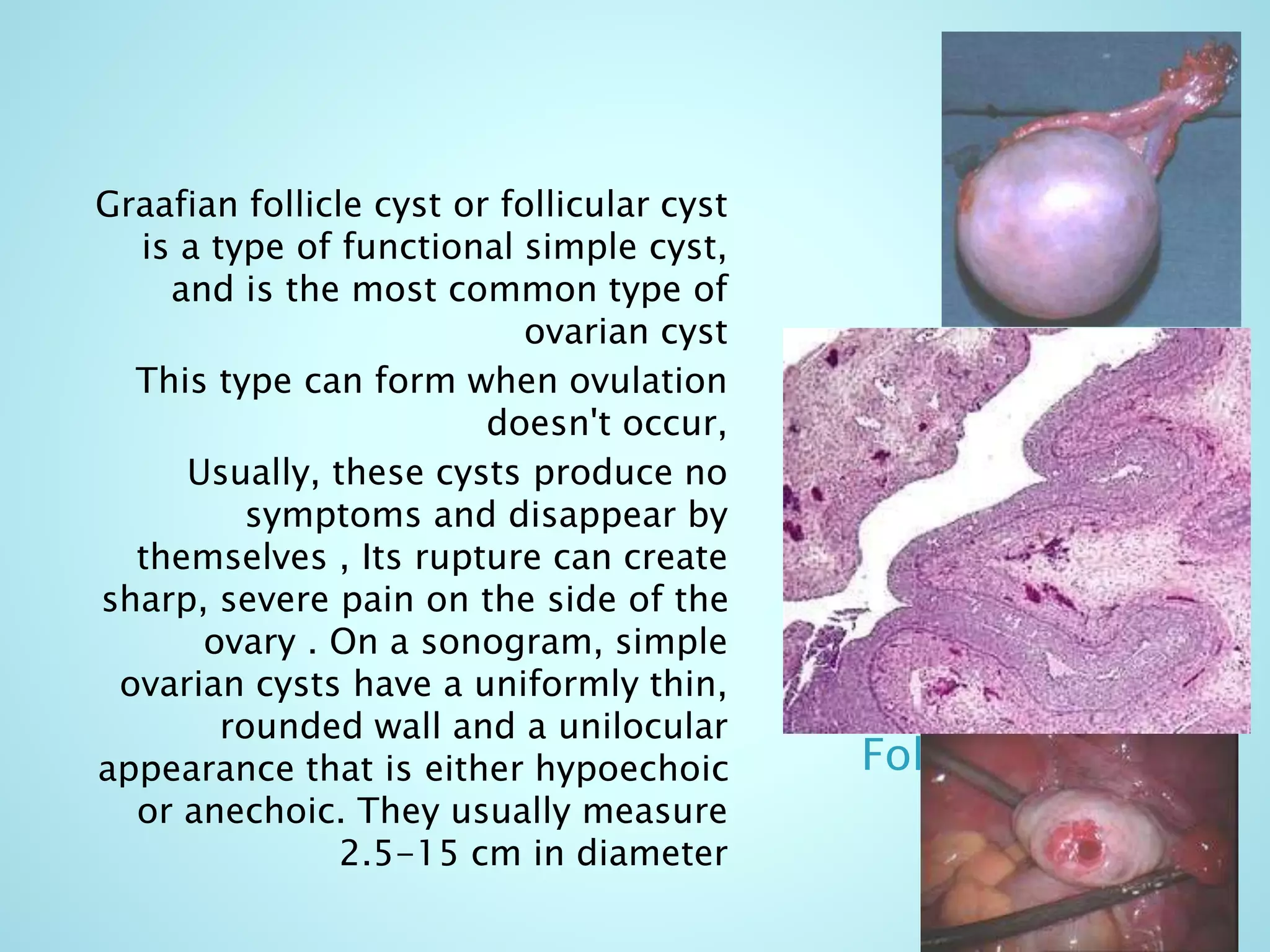 Benign diseases of the ovary | PPTX