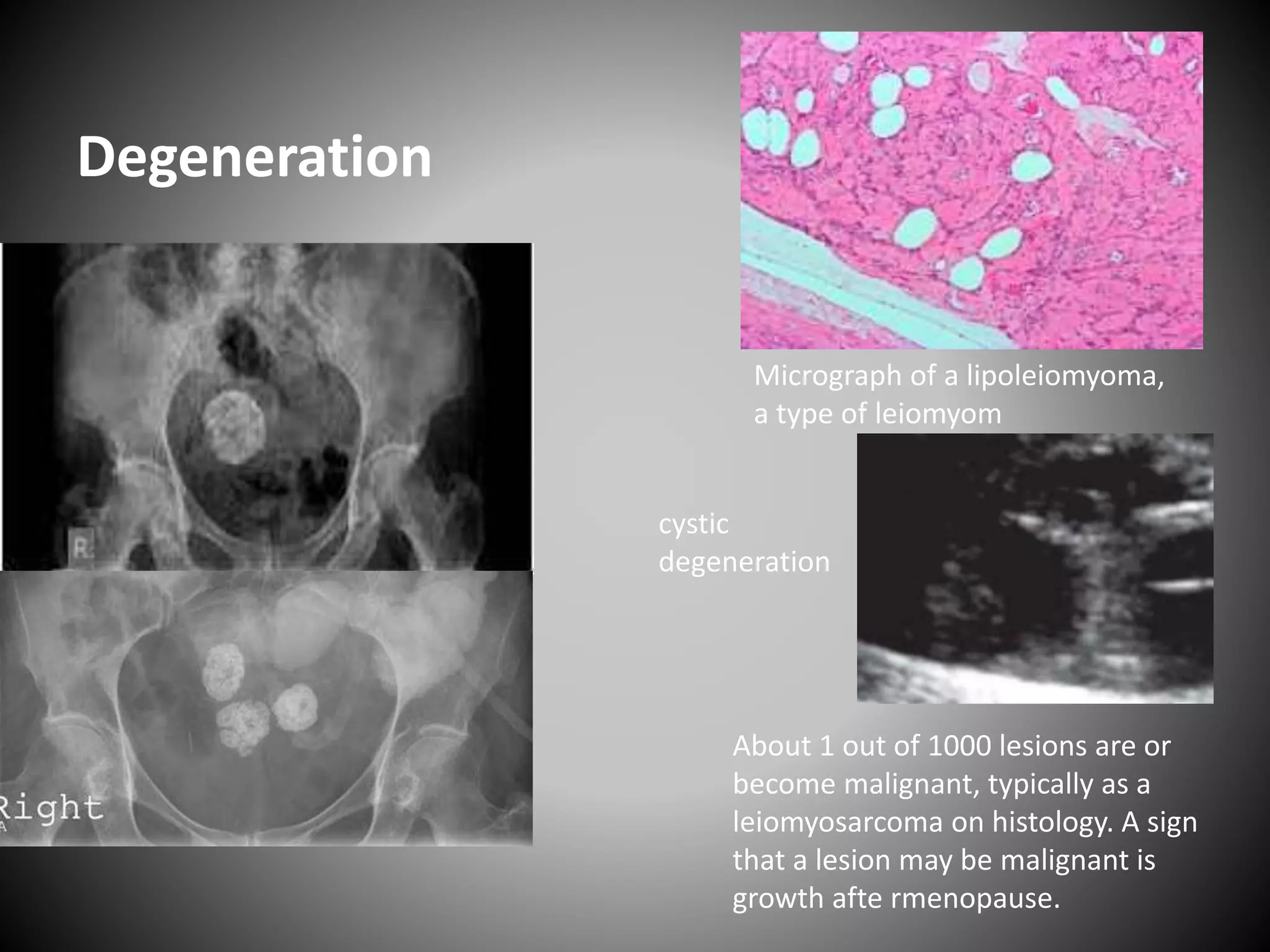 Benign diseases of the uterus and cervix | PPTX