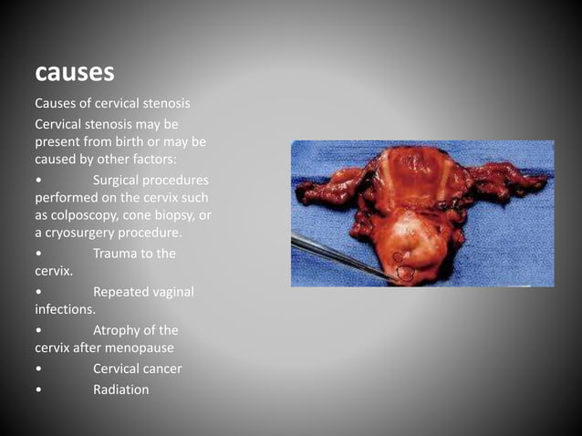 Benign diseases of the uterus and cervix | PPTX | Pregnancy ...