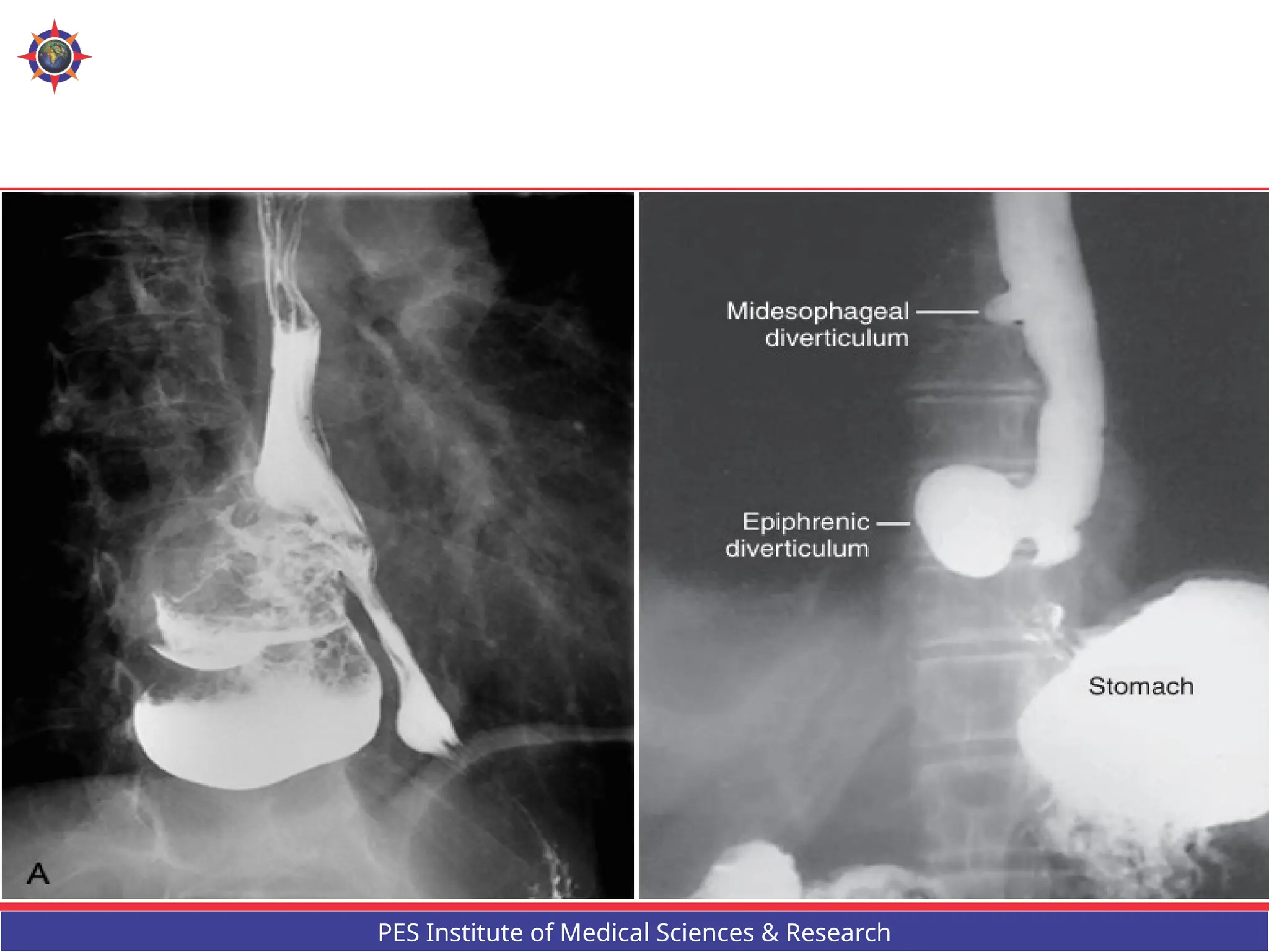 Benign disorders of esophagus FINAL.pptx