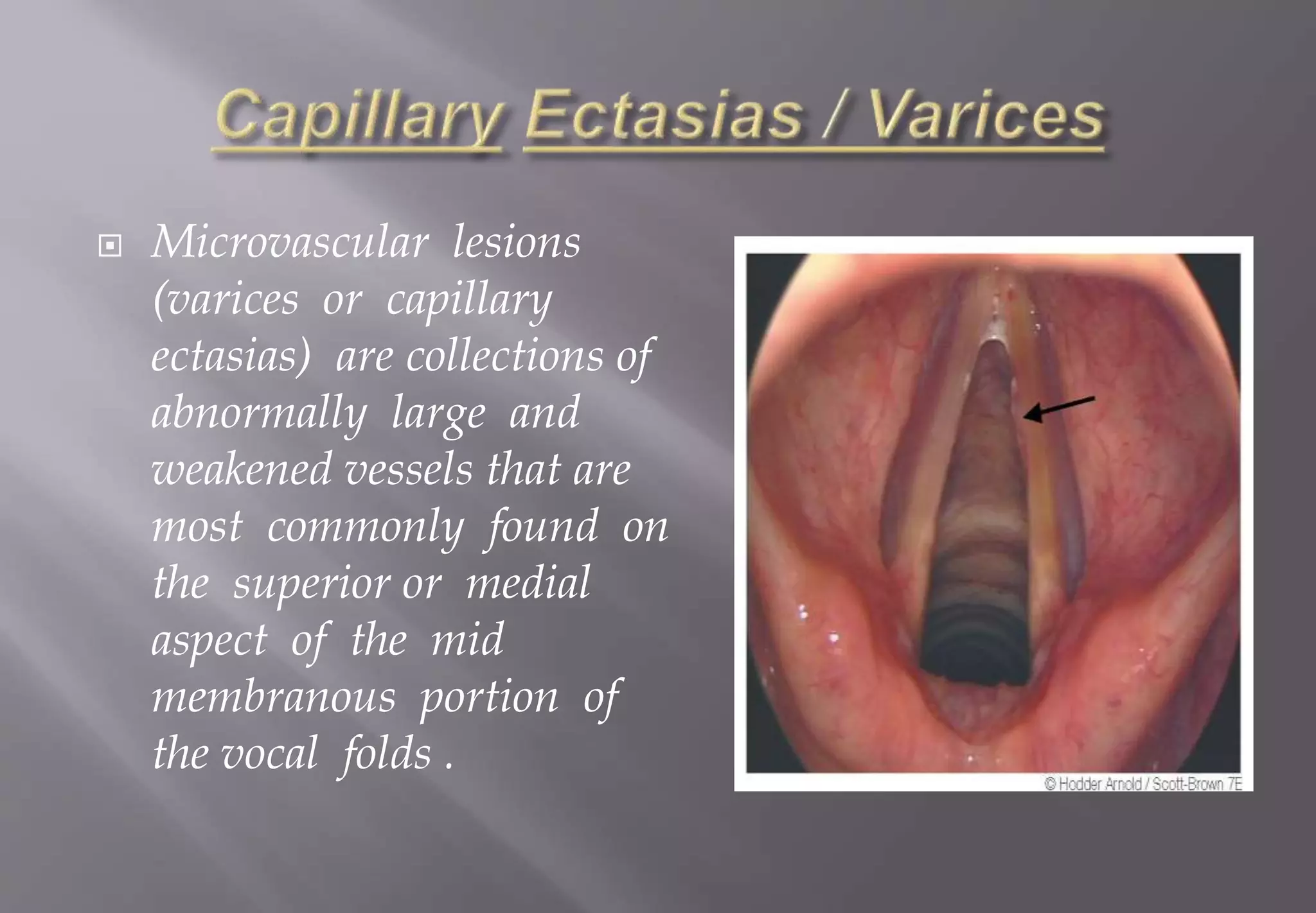 Benign disorders of larynx | PPTX