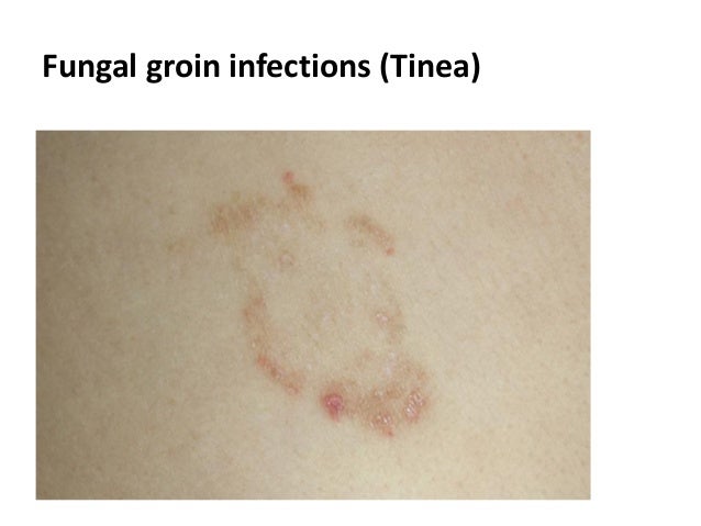 Benign Disorders of the Vulva: Pruritus (itchy) Vulva Vulval Skin and…