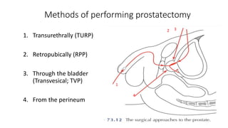 Benign enlargement of prostate | PPTX