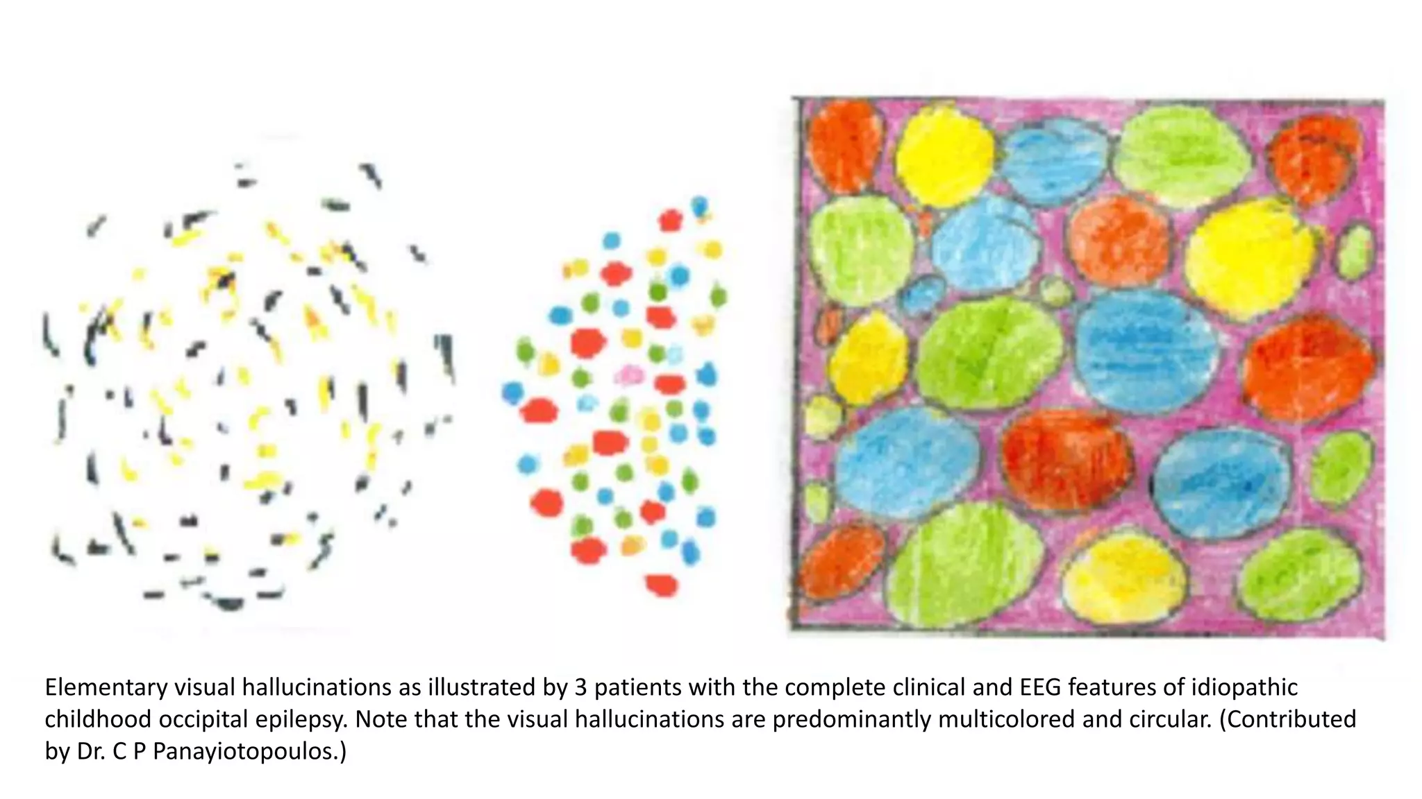 Benign epileptic syndromes | PPTX