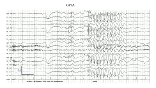 Benign epileptic syndromes | PPTX