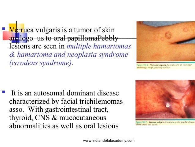 Benign epithelial tumors/prosthodontic courses