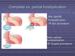 benign esophagus disorder | PPT