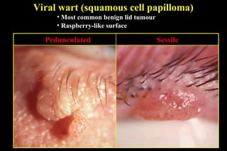 Benign Eyelid Lesions for postgraduate students | PPT