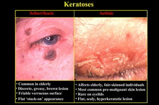 Benign Eyelid Lesions for postgraduate students | PPT | Skin and ...
