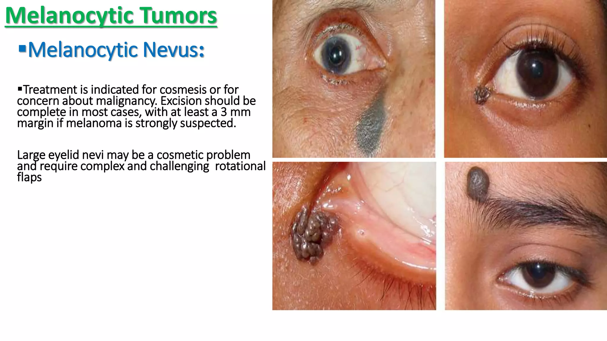Benign eyelid tumors | PPTX