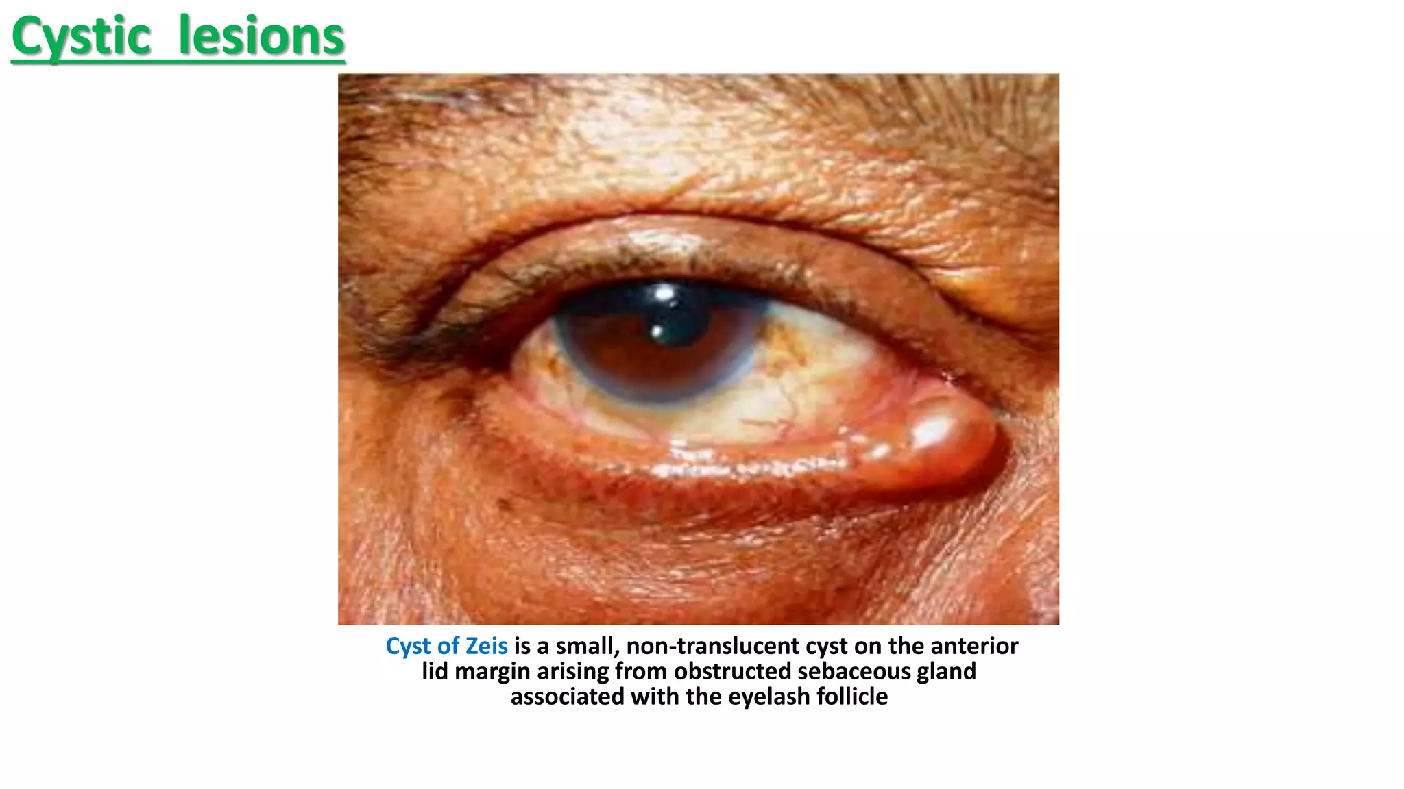 Benign eyelid tumors | PPTX