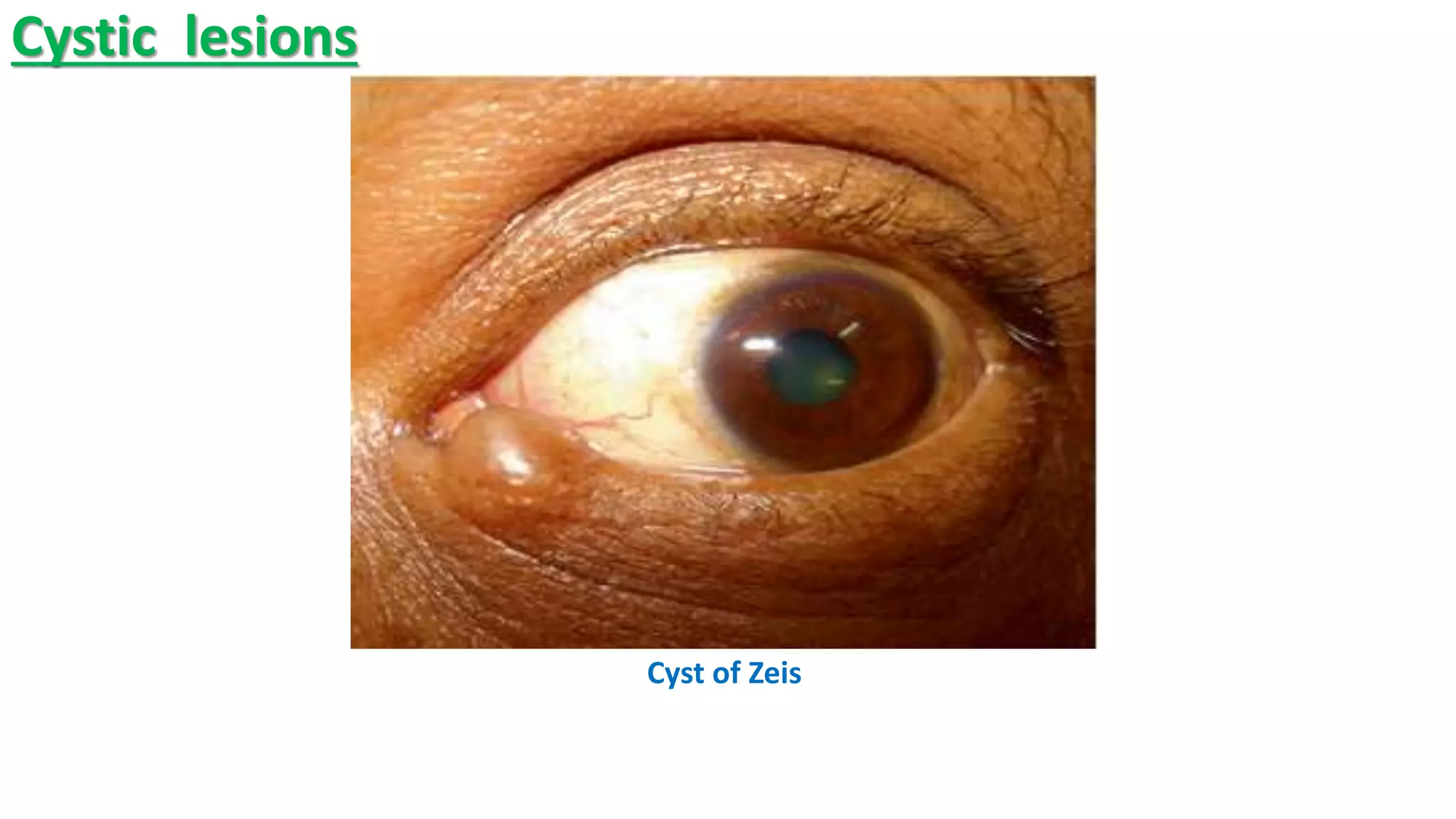 Benign eyelid tumors | PPTX