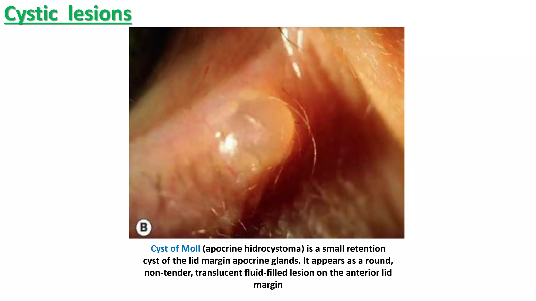 Benign eyelid tumors | PPTX