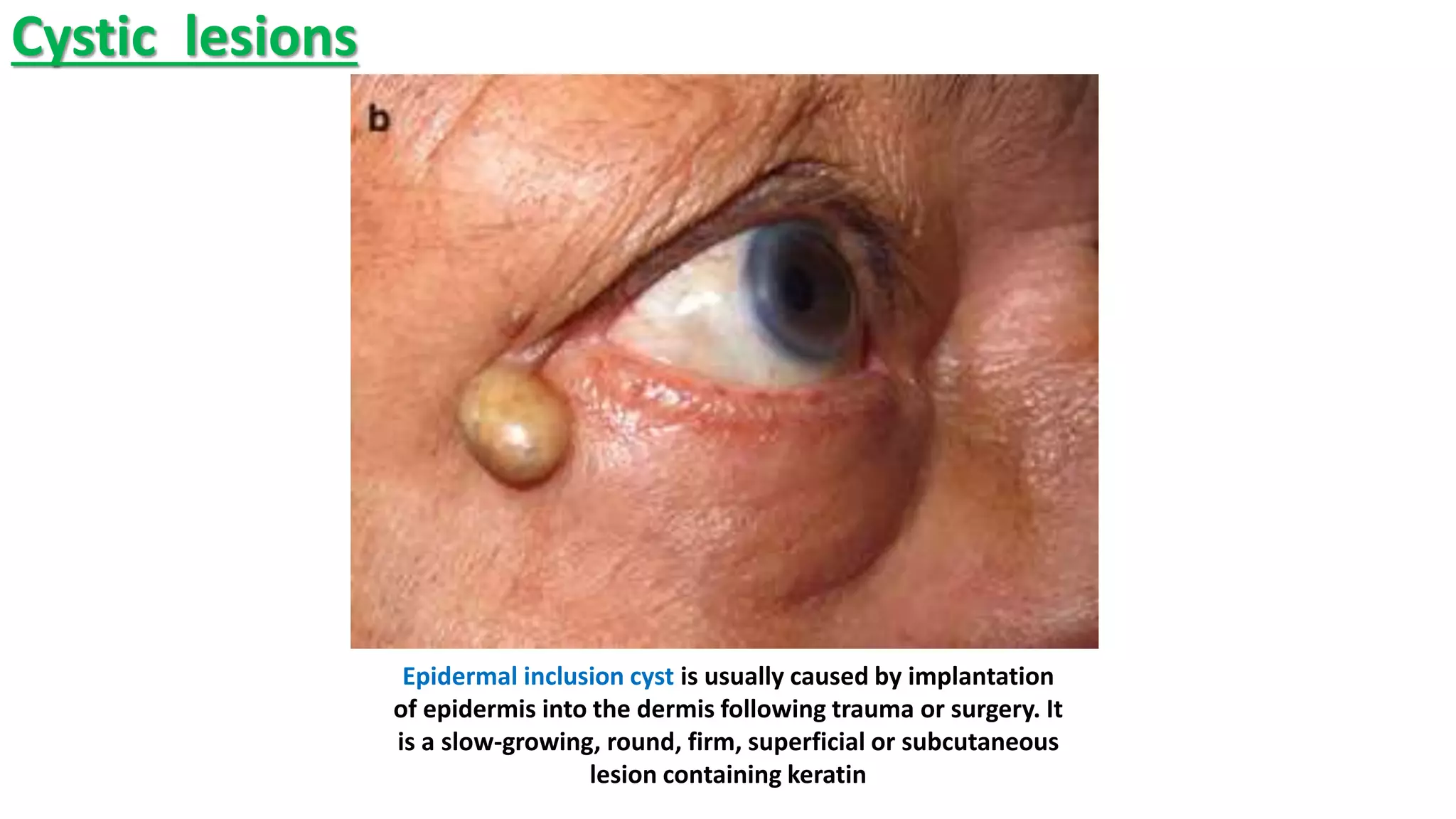 Benign eyelid tumors | PPTX