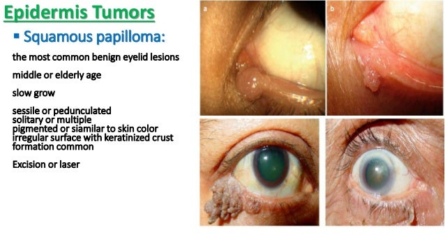 Benign eyelid tumors