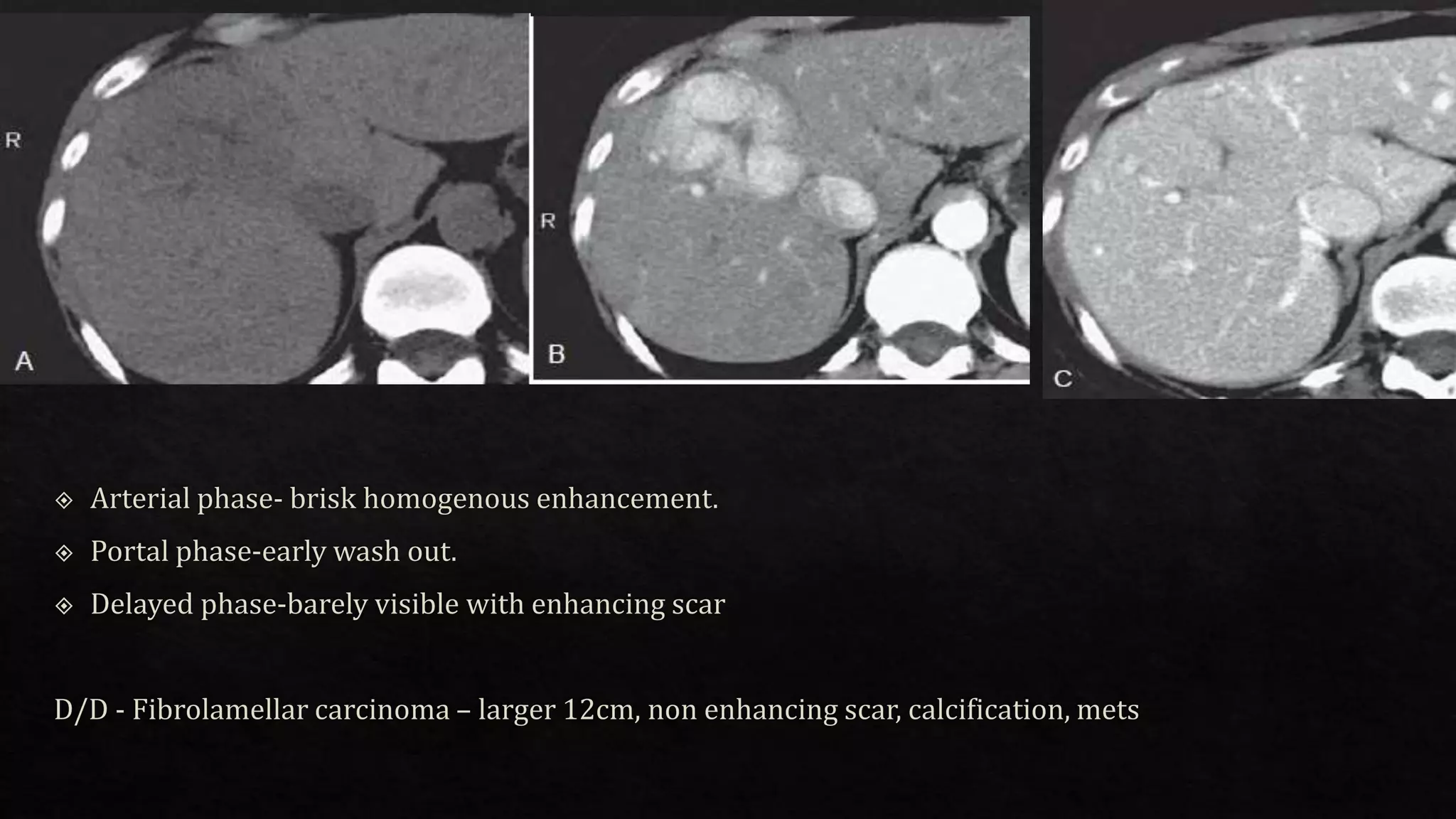 Imaging of benign focal hepatic lesions | PPTX