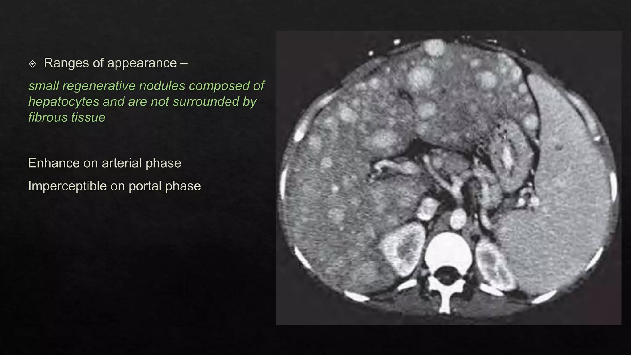 Imaging of benign focal hepatic lesions | PPTX