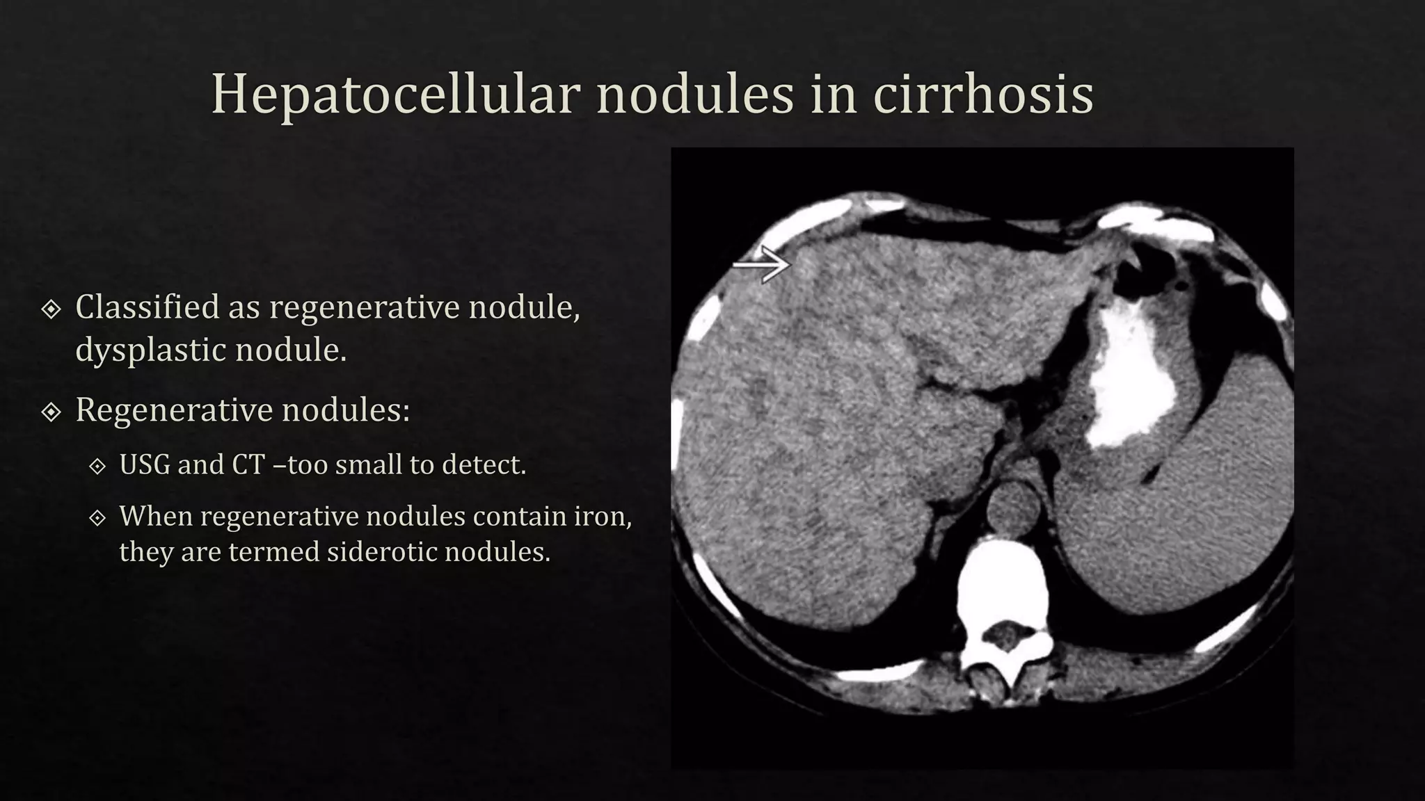 Imaging of benign focal hepatic lesions | PPTX