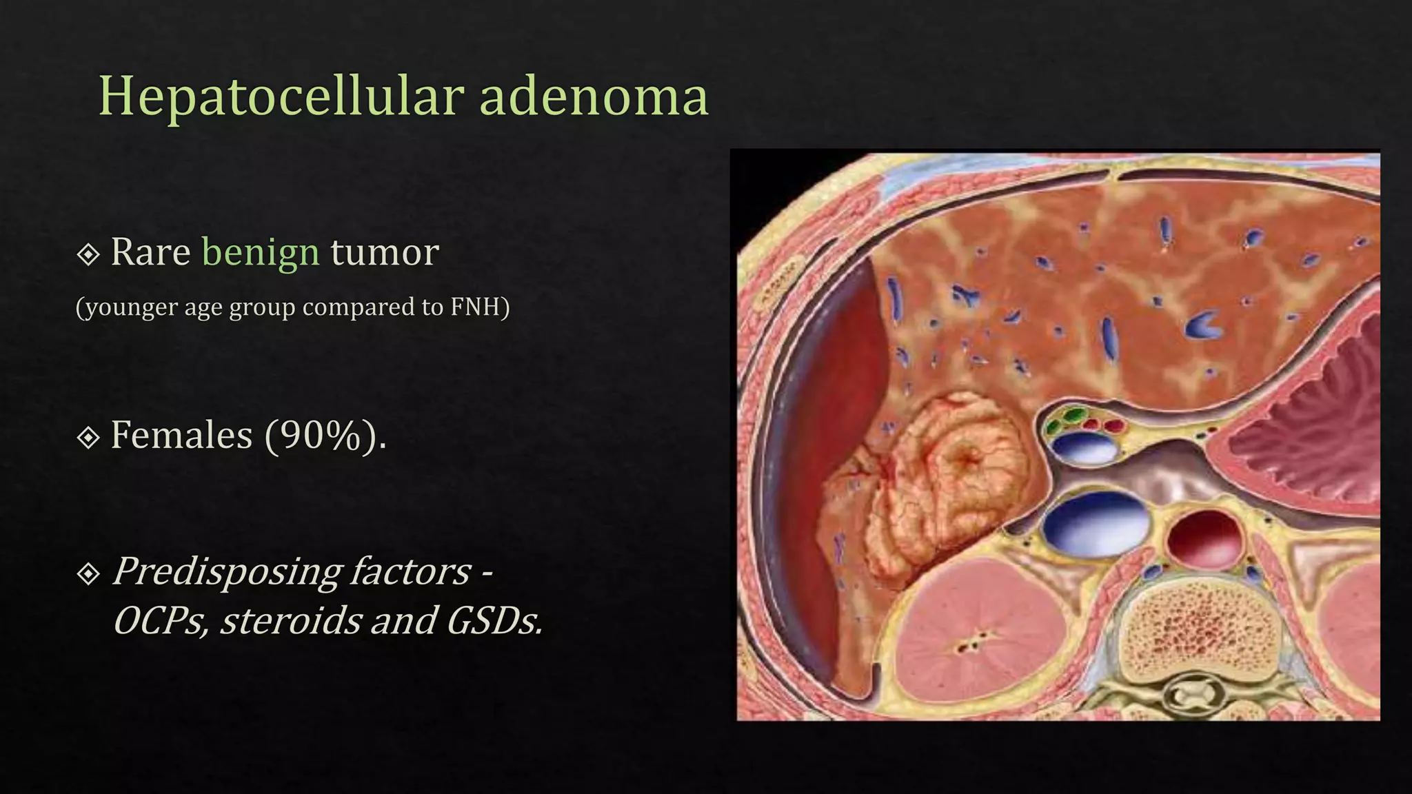 Imaging of benign focal hepatic lesions | PPTX
