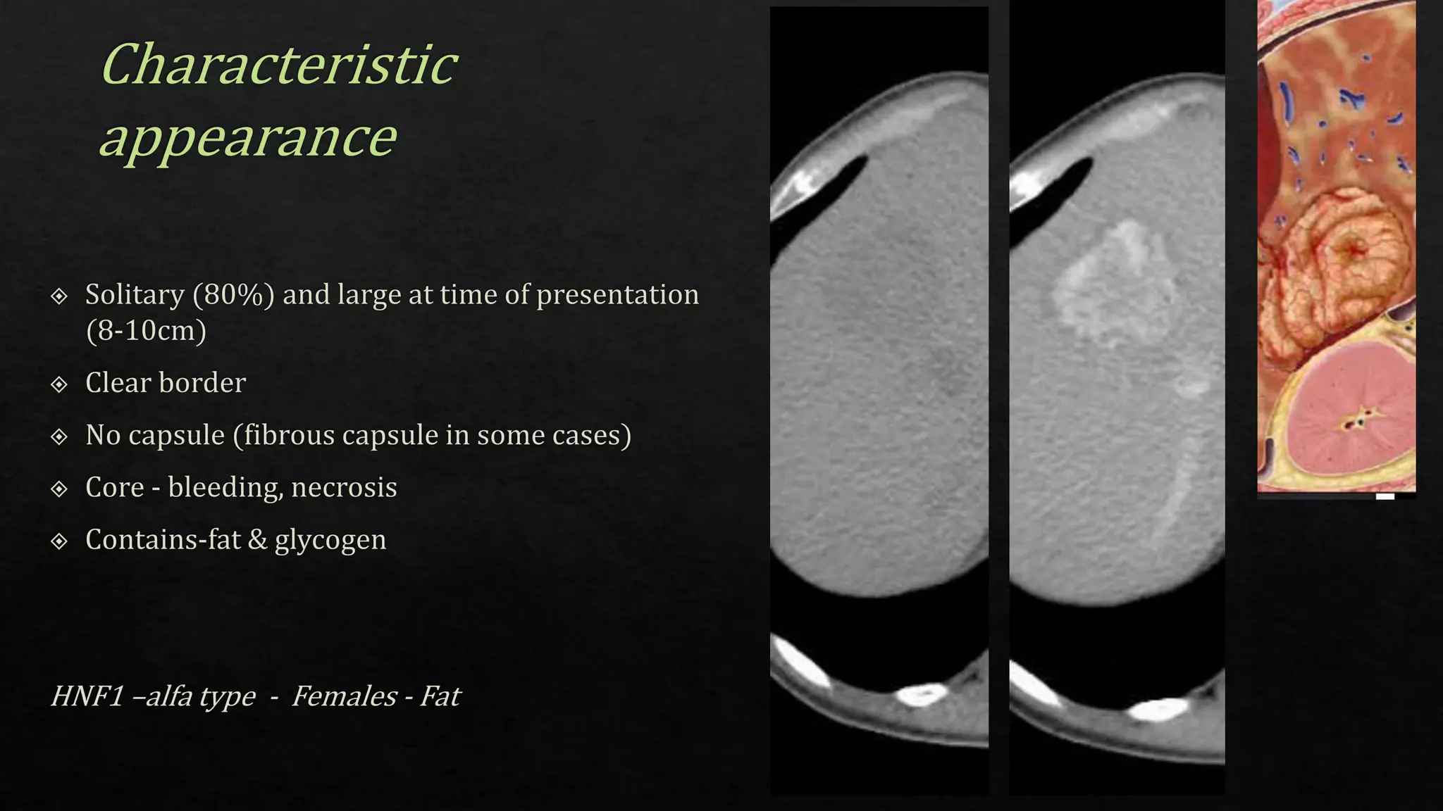 Imaging of benign focal hepatic lesions | PPTX