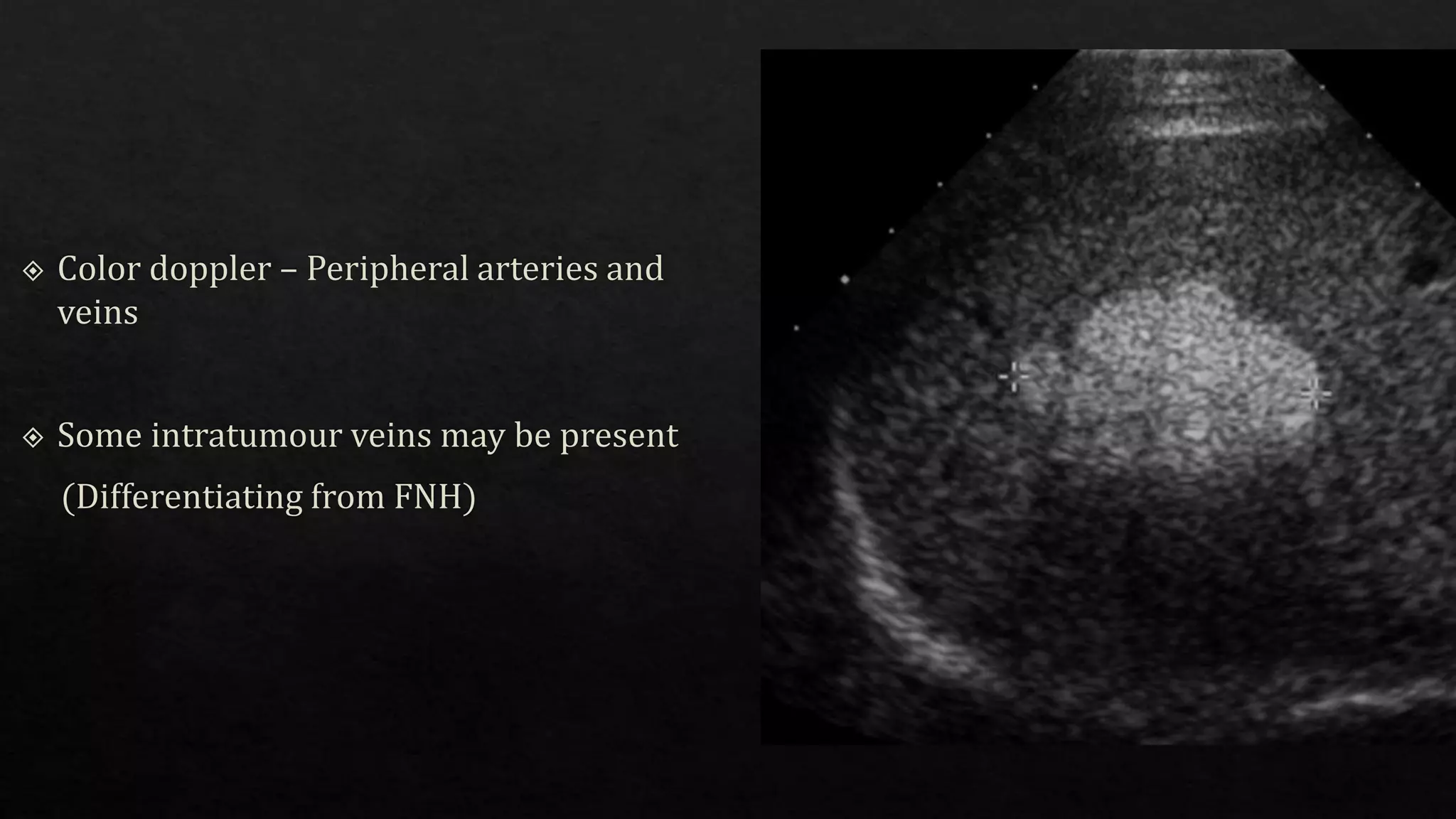 Imaging of benign focal hepatic lesions | PPTX